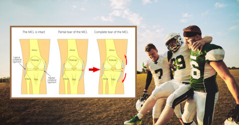 How to Heal an MCL Tear - Comprehensive Orthopaedics