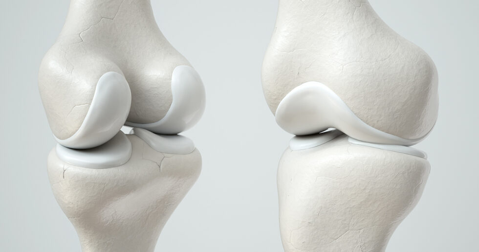Humans May Possess Ability to Regrow Cartilage - Comprehensive Orthopaedics