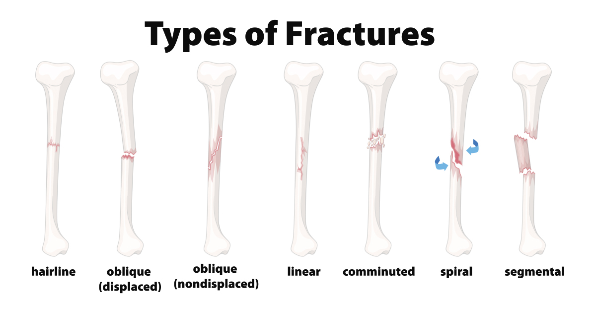Longitudinal Fracture
