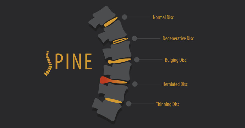 The Most Common Back Surgeries, Explained - Comprehensive Orthopaedics