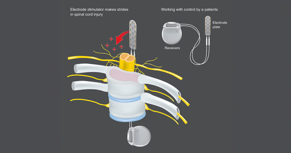 Spinal Cord Stimulation Eases Pain, Boosts Function for People With ...